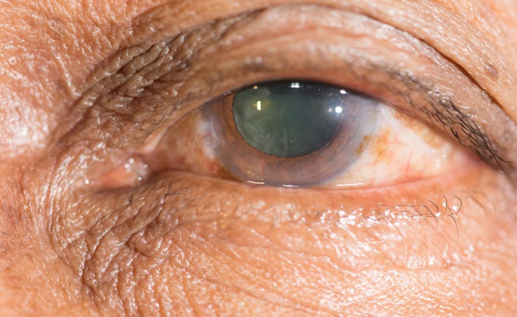 ¿Qué son las cataratas en los ojos? | Clínica Internacional